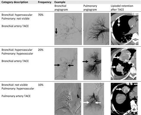 Bronchial Or Pulmonary Artery Chemoembolization For Unresectable And Unablatable Lung Metastases