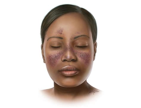 How Women Can Manage Various Types Of Lupus Tribune Online
