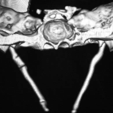 Right Lateral View Showing Segmentations Along Elongated Styloid