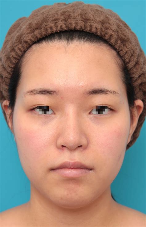 先日アップした、鼻シリコンプロテーゼ＋鼻先耳介軟骨移植＋小鼻縮小を行った20代女性症例写真の解説 美容整形高須クリニック 高須 幹弥