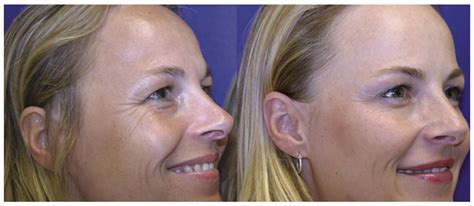 Mi By Lee — Preventative Botox A Study On Identical Twins