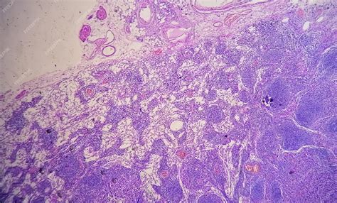 Premium Photo Photomicrograph Of Stomach Adenocarcinoma Gastric