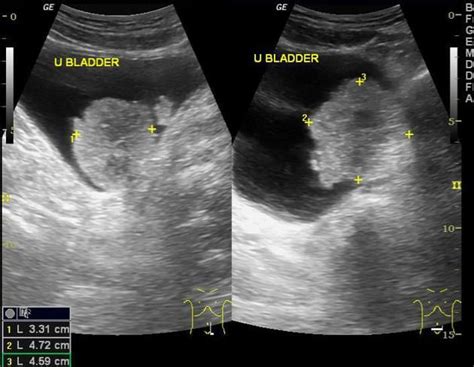 Pin By Ian Bickle On Urogenital Radiology Medical Ultrasound