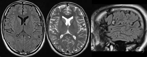 龚德山教授团队:左侧中央盖海绵状血管瘤切除病例一例 脑医汇 龚德山教授团队:左侧中央盖海绵状血管瘤切除病例一例 脑医汇