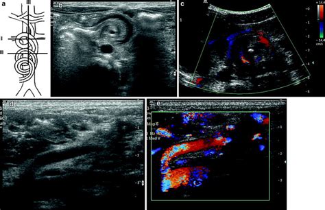 Hernias Volvulus And Intussusception Abdominal Key