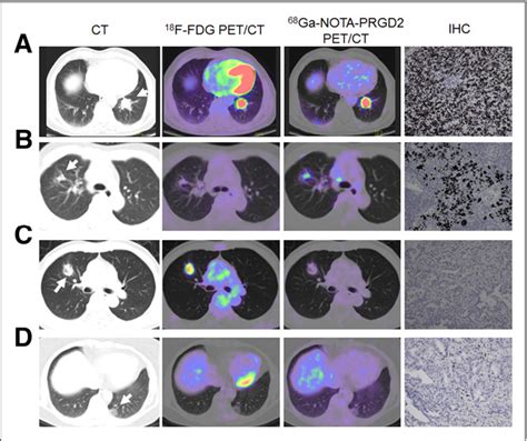 Figure 1 From 68ga Nota Prgd2 Petct For Integrin Imaging In Patients