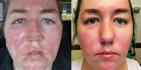 Woman Photos Show The Healing Process Of Second Degree Burns Business