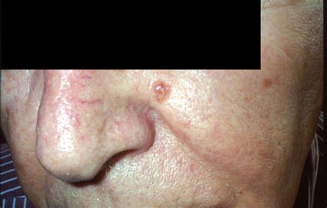 Malignant Lesions Basal Cell Carcinoma Picture Hellenic
