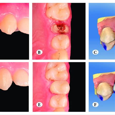 A Buccal View B Occlusal View C Virtual Model D Buccal View Of