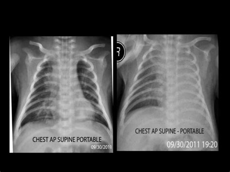 Neonatal Pneumonia