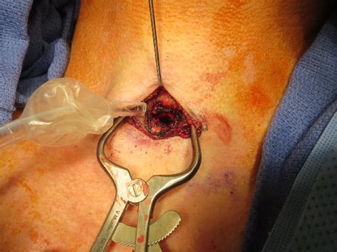 Cricothyrotomy For Elective Difficult Airway Management Iowa Head And