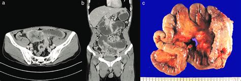 Abdominal Computed Tomography Ct Scan Revealed Multiple Polypoid