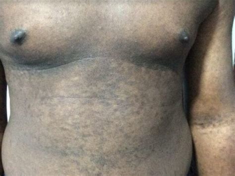 Clinical Challenge Widespread Skin Pigmentation Mpr