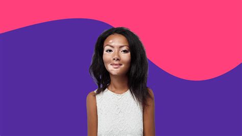 What Causes Vitiligo Diagnosis Prevention And Treatment