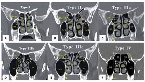 Ct Scan Shows The Pneumatized Types And Adjacent Structure Of Psms A Download Scientific