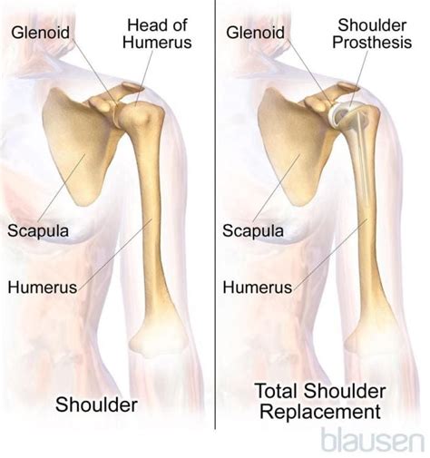 Image Total Shoulder Replacement Arthroplasty Msd Manual Consumer