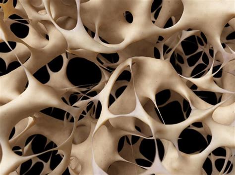 Osteoporosis El 20 De Los Hombres Corre Riesgo De Fracturas Luego De