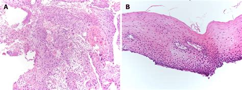 Pathological Examination Biopsy From Primary Lesion A Initial Biopsy