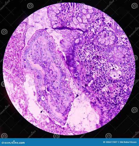 Chronic Nonspecific Ileitis With Ulcer Ibd Stock Image Image Of Alimentary Gastrointestinal