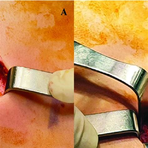 Anterior Mediastinotomy A And Sampling Of Mediastinal Mass With