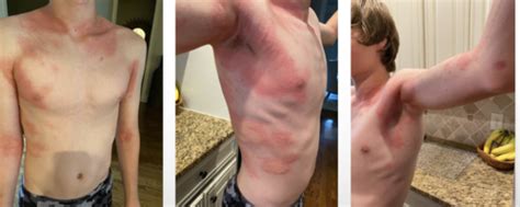 Immunology Flashcards Quizlet