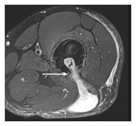 A 30 Year Old Systemically Well Man With Chronic Osteomyelitis Who Download Scientific Diagram