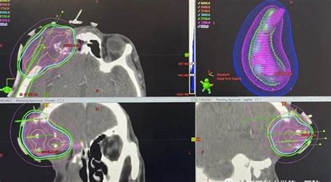 Implantation And Radiotherapy For Recurrent Head And Neck Tumors Guided