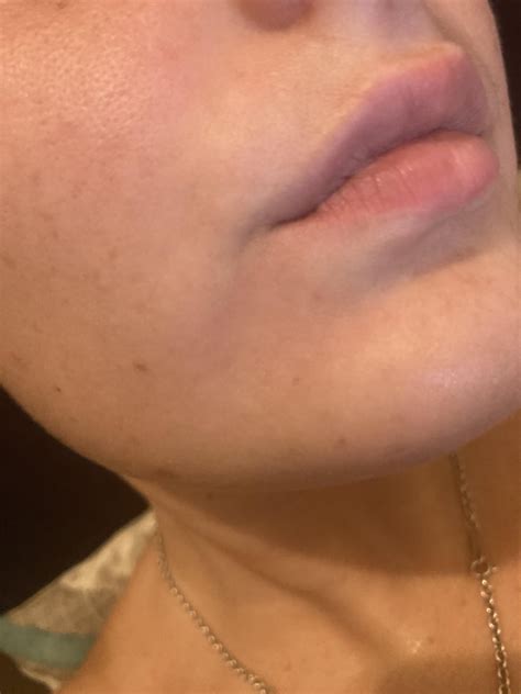 Differin Dark Spot Is Magic R Skincare Addiction