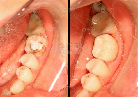 病理学高清图片 牙齿修复前后对比 牙齿修复前后对比图片免费下载 5157586468 千图网pro