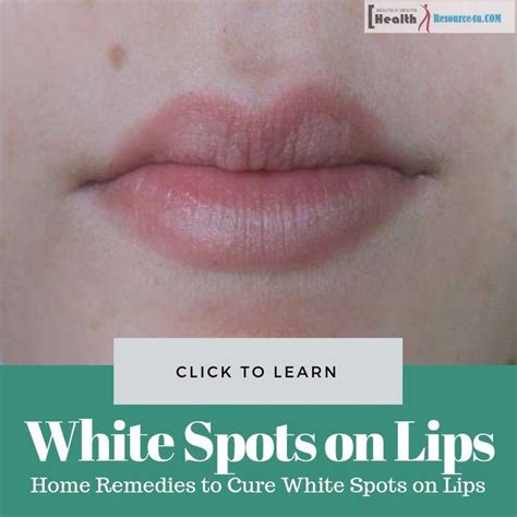 7 Effective Home Remedies To Cure White Spots On Lips Lips The Cure