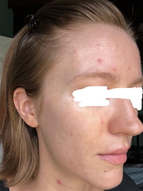 Forehead Texture And Redness Is A Persistent Problem Rskincareaddiction