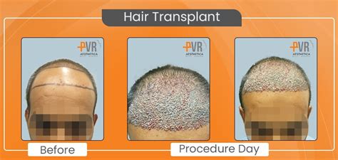 Best Hair Transplant Doctor In Navi Mumbai PVR Aesthetica