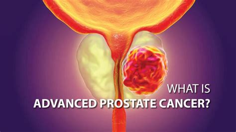 Navigating The Stage 4 Prostate Cancer Journey Dr Dushyant