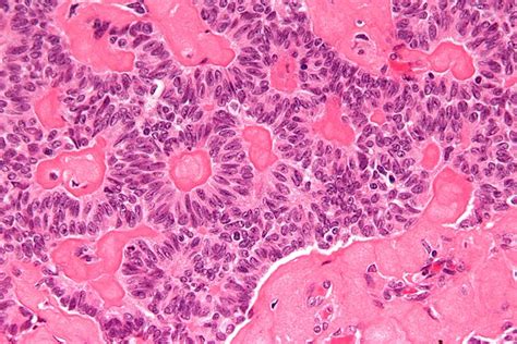 Sex Cord Tumour With Annular Tubules Libre Pathology