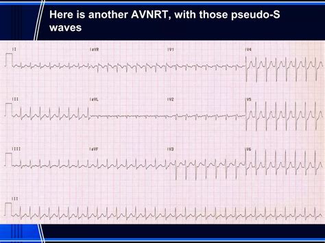 ecg approach to arrhythmias 2017 ppt