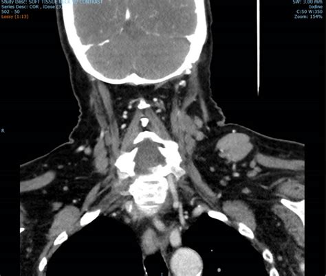 Coronal Ct Soft Tissue Virchows Node Download Scientific Diagram