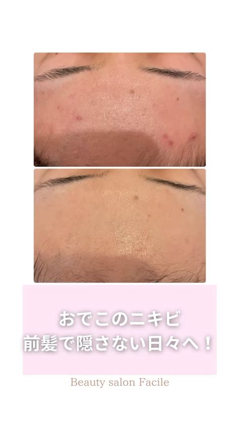 【太田市 エステ 肌質改善 ハーブピーリング肌荒れを隠さな ブログ 群馬県太田市のエステならbeauty Salon Facile