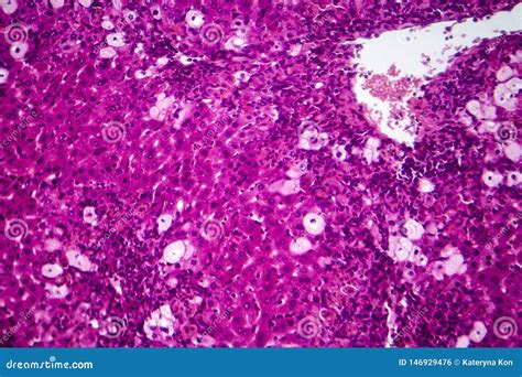 Hepatite Viral Micrografia Leve Ilustração Stock Ilustração de agudo