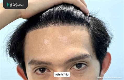 รีวิวโปรแกรมฉีด Prp บำรุงรากผม ที่ Chrio Clinic Hdmall
