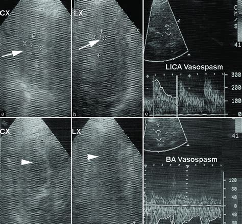 A F Shows Clot In Pretreatment Two Dimensional Echocardiography