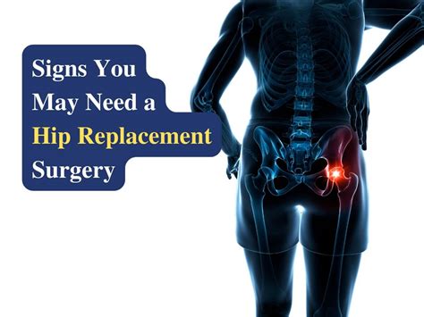 Signs You Might Need Hip Replacement Surgery Expert Insights