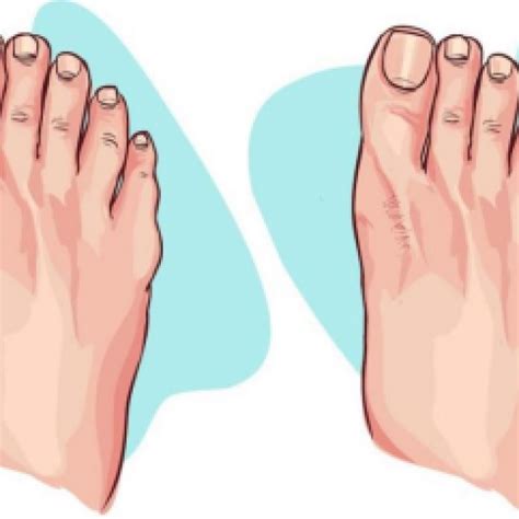 Understanding Gout Causes Symptoms And Treatment