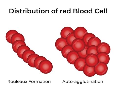 Premium Vector Distribution Of Red Blood Cell Rouleaux Formation Auto