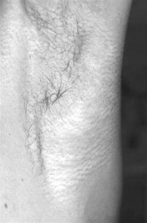 Pseudoxanthoma Elasticum A Clinical Pathophysiological And Genetic Update Including 11 Novel