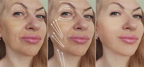 Woman Face Wrinkles Before And After Removal Facial Injection