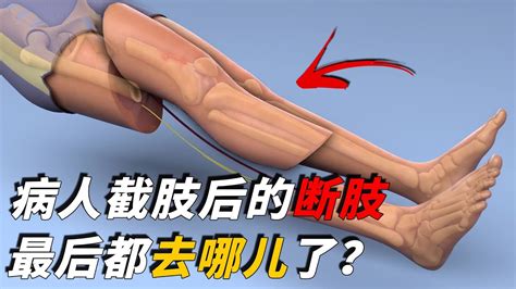 病人截肢手术后的断肢最后都去哪儿了答案或超出你的想象脑洞科普君 YouTube
