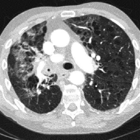Tumor Obstructing The Bronchus Intermedius There Is Evidence Of