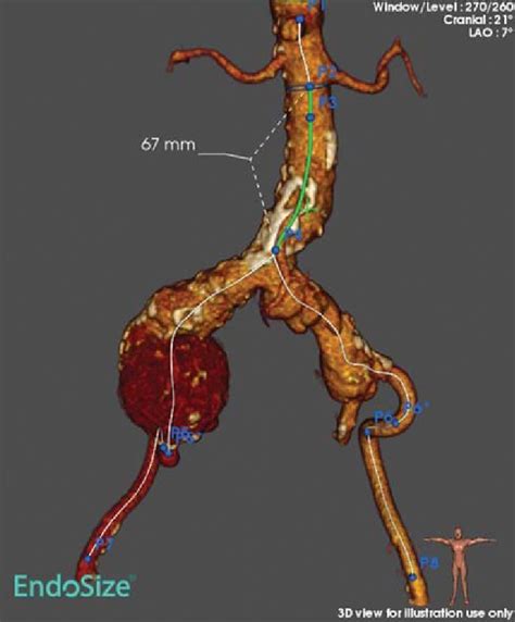 Three Dimensional Reconstruction Computed Tomography Image Arterial