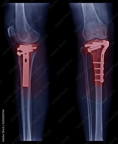X Ray Image Of Bone Fracture At Tibia And Fibular Right Leg Open Reduction Internal Fixation