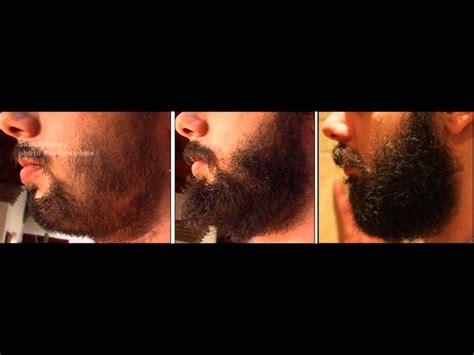 Minoxidil Beard Growth Before After Man Health Magazine Online